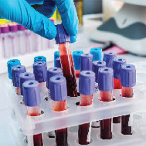 PSA Velocity Test: New Tool In Fight Against Prostate Cancer